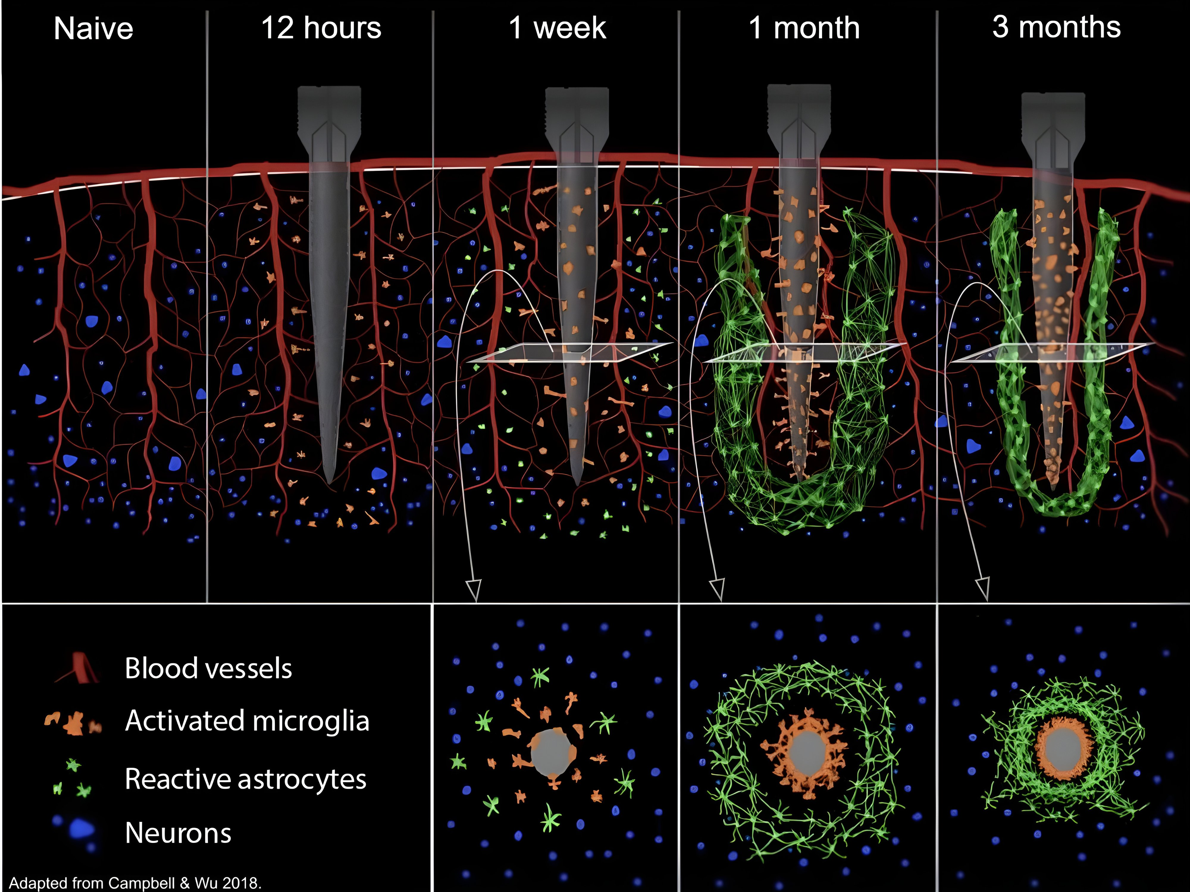 Neuralink Upgrades N1 Brain Implant: 1.5-Second Thread Insertion and ...